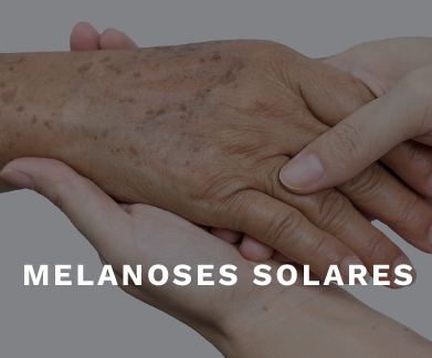 MELANOSES SOLARES - dermatologista Passo Fundo dermatologia passo fundo ...