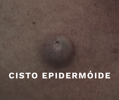 CISTO EPIDERMÓIDE - dermatologista Passo Fundo dermatologia passo fundo dermato passo fundo ...